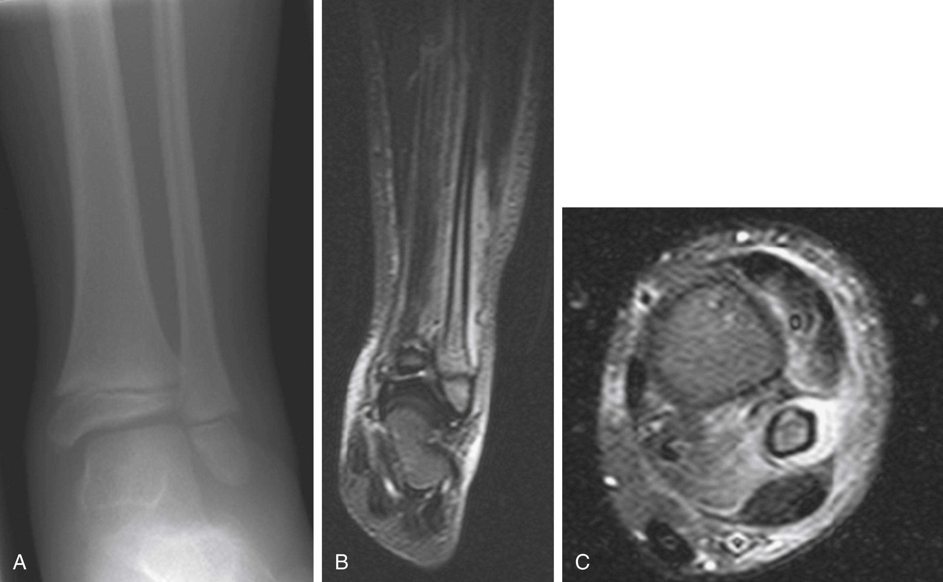 Infections of the Musculoskeletal System - Clinical Tree