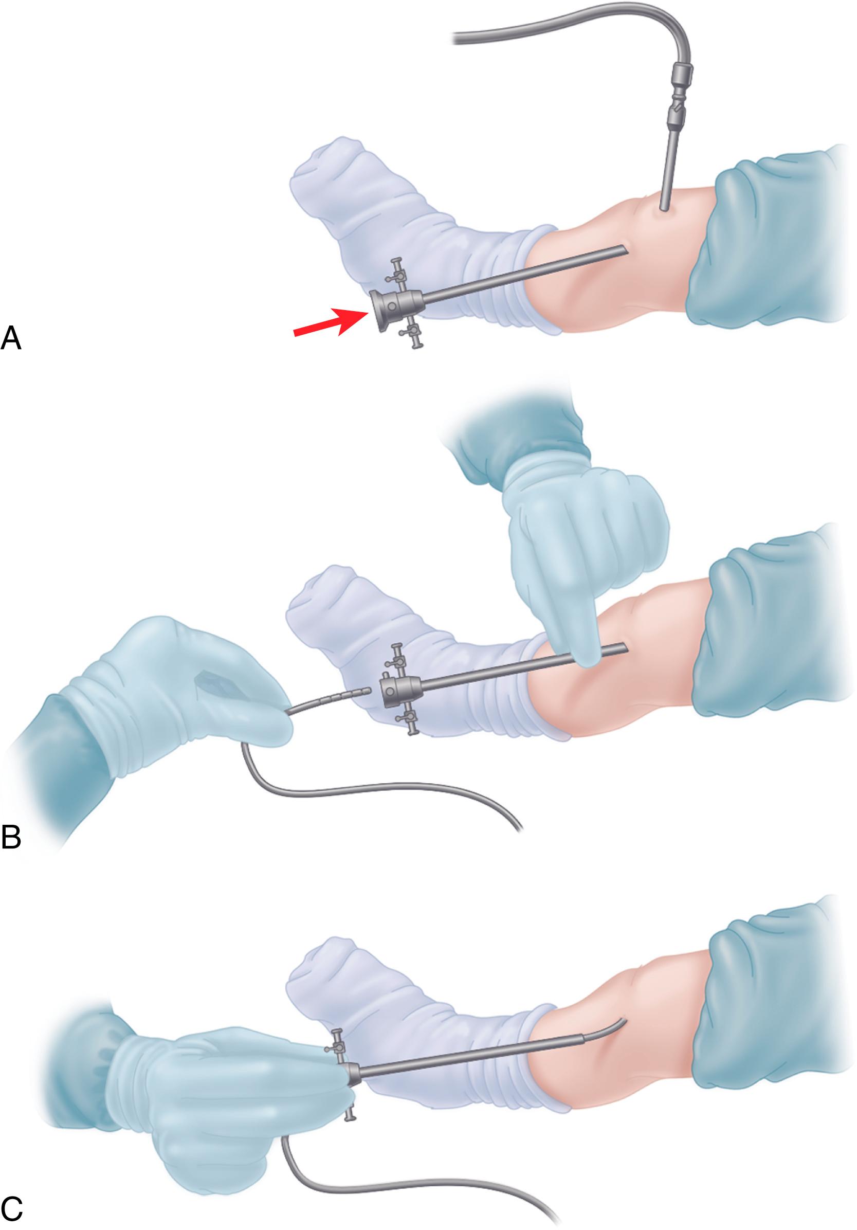 Infectious Arthritis - Clinical Tree