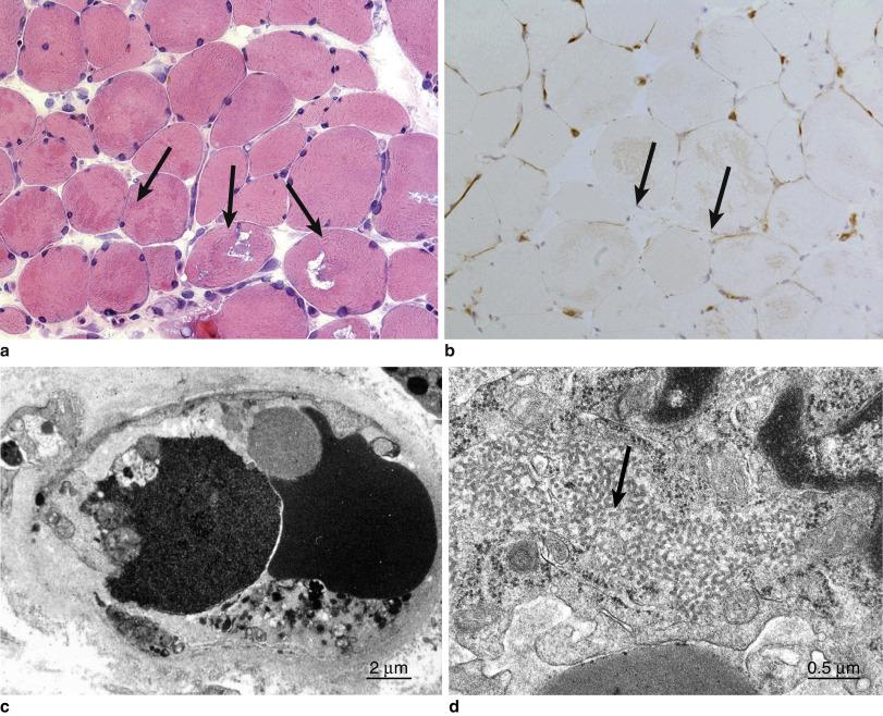 Inflammatory Myopathies - Clinical Tree