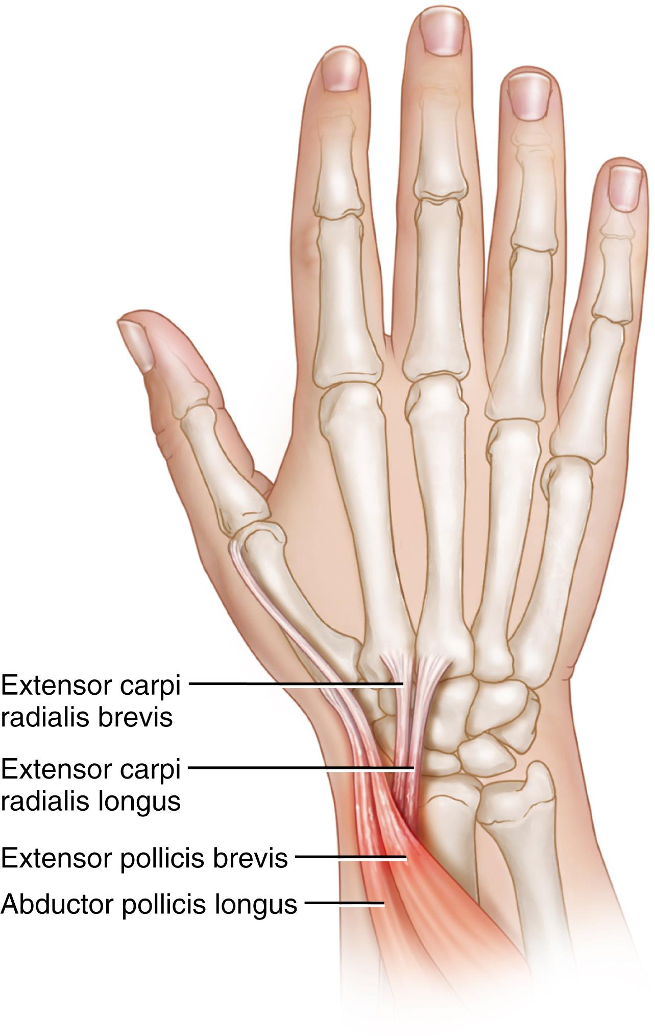 Injection Technique for Intersection Syndrome - Clinical Tree Injection Technique for Intersection Syndrome - Clinical Tree