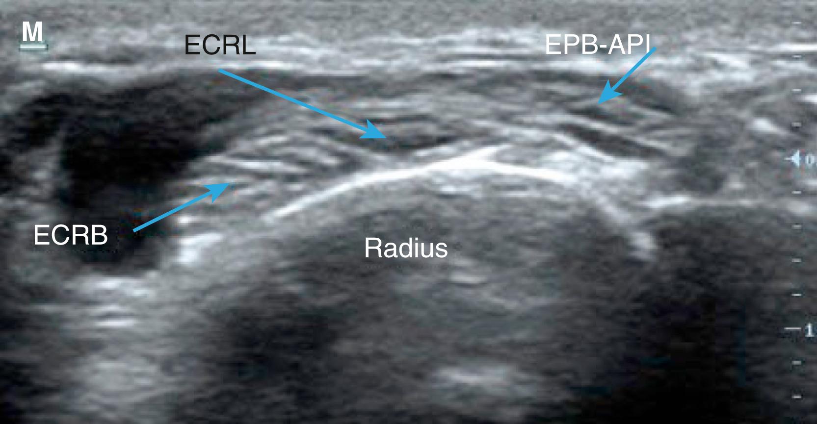 Injection Technique For Intersection Syndrome Clinical Tree