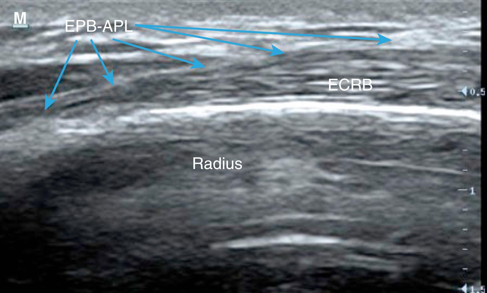 Injection Technique For Intersection Syndrome Clinical Tree