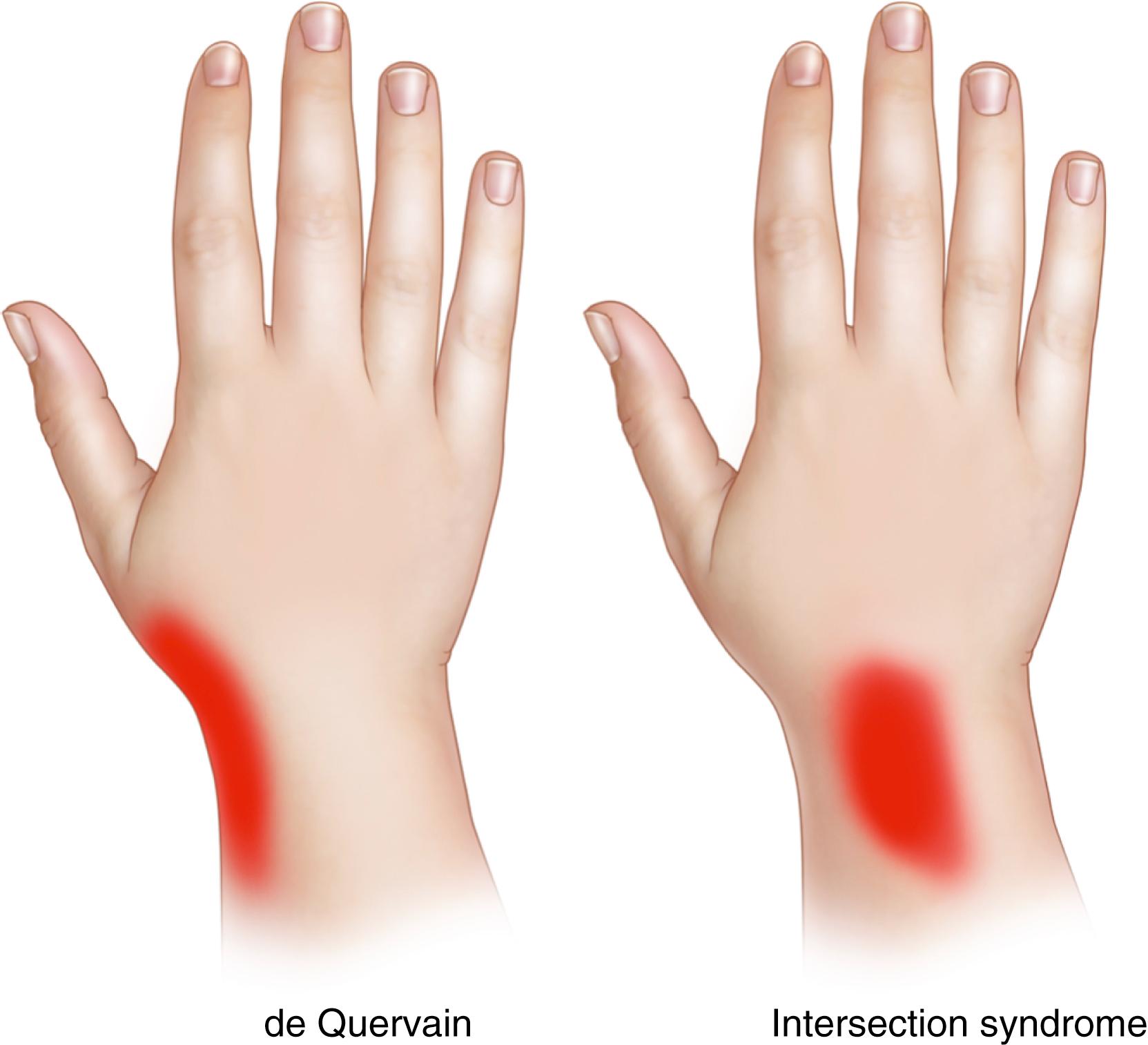 Injection Technique for Intersection Syndrome - Clinical Tree Injection Technique for Intersection Syndrome - Clinical Tree