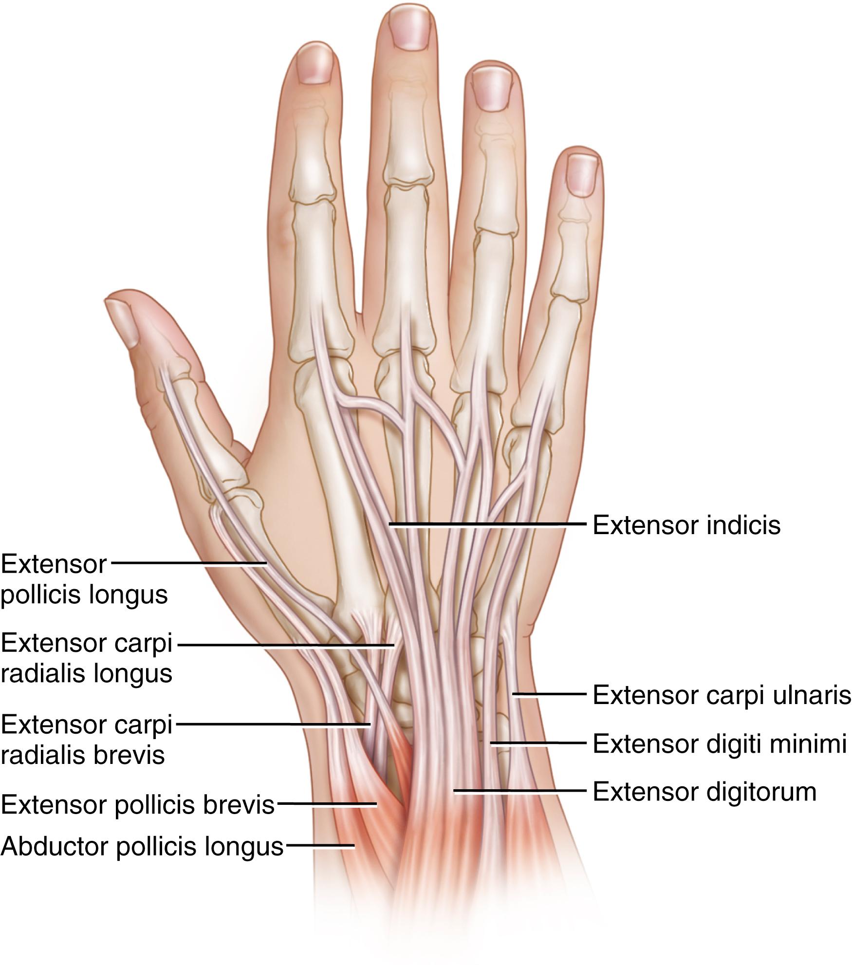 Injection Technique for Intersection Syndrome - Clinical Tree Injection Technique for Intersection Syndrome - Clinical Tree
