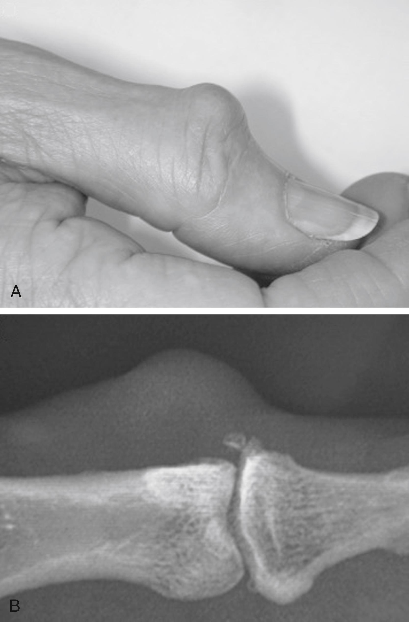 Injection Technique For Mucous Cysts Of The Fingers Clinical Tree