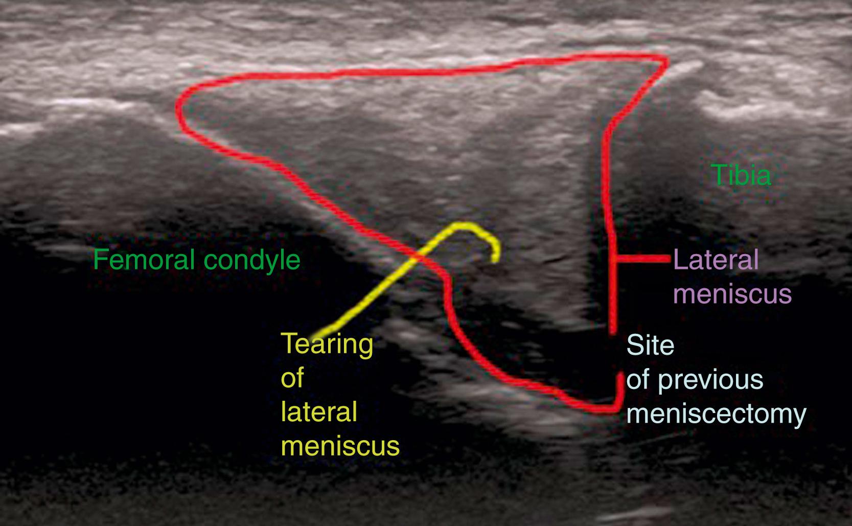 Intra-Articular Injection of the Knee Joint—Lateral Mid-Patellar ...