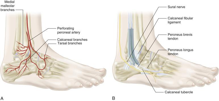 Intraarticular Calcaneus Fractures - Clinical Tree