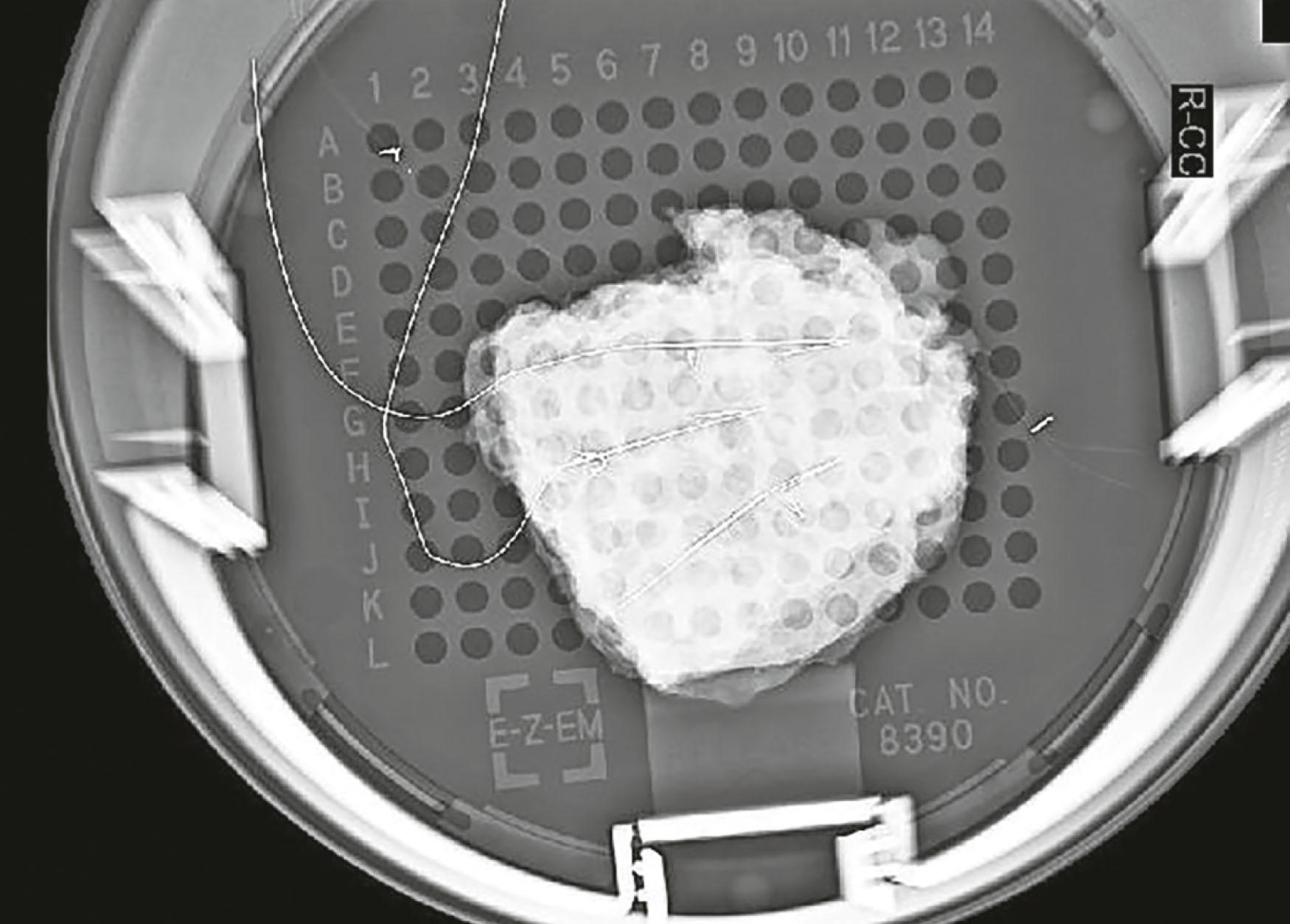 Intraoperative Evaluation Of Surgical Margins In Breast Conserving Therapy Clinical Tree