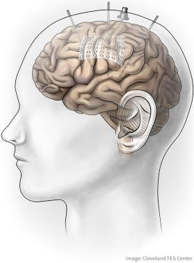 Invasive Brain–Computer Interfaces for Functional Restoration ...