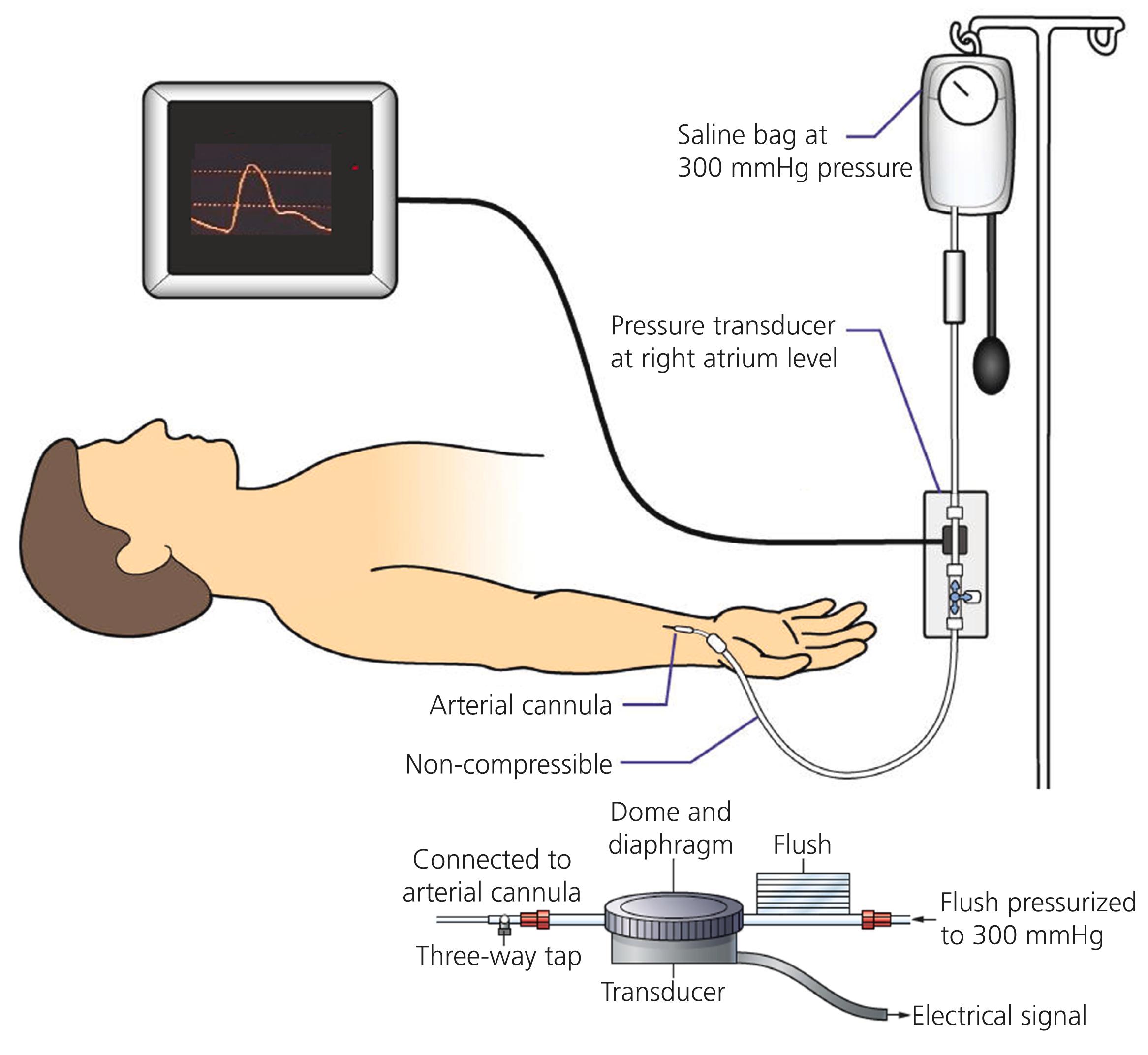 Invasive monitoring - Clinical Tree