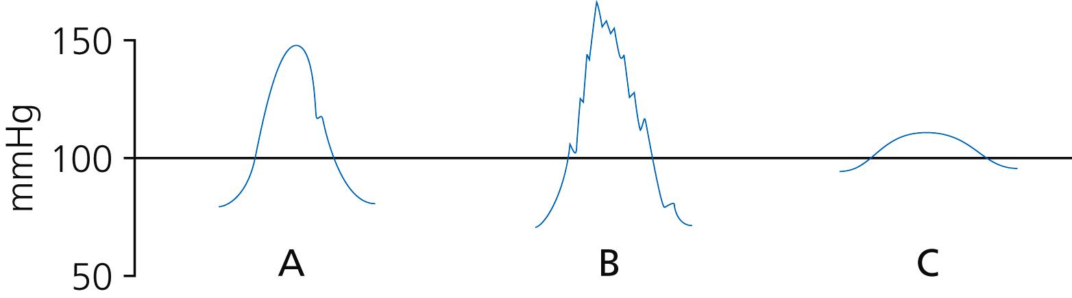 Invasive monitoring - Clinical Tree