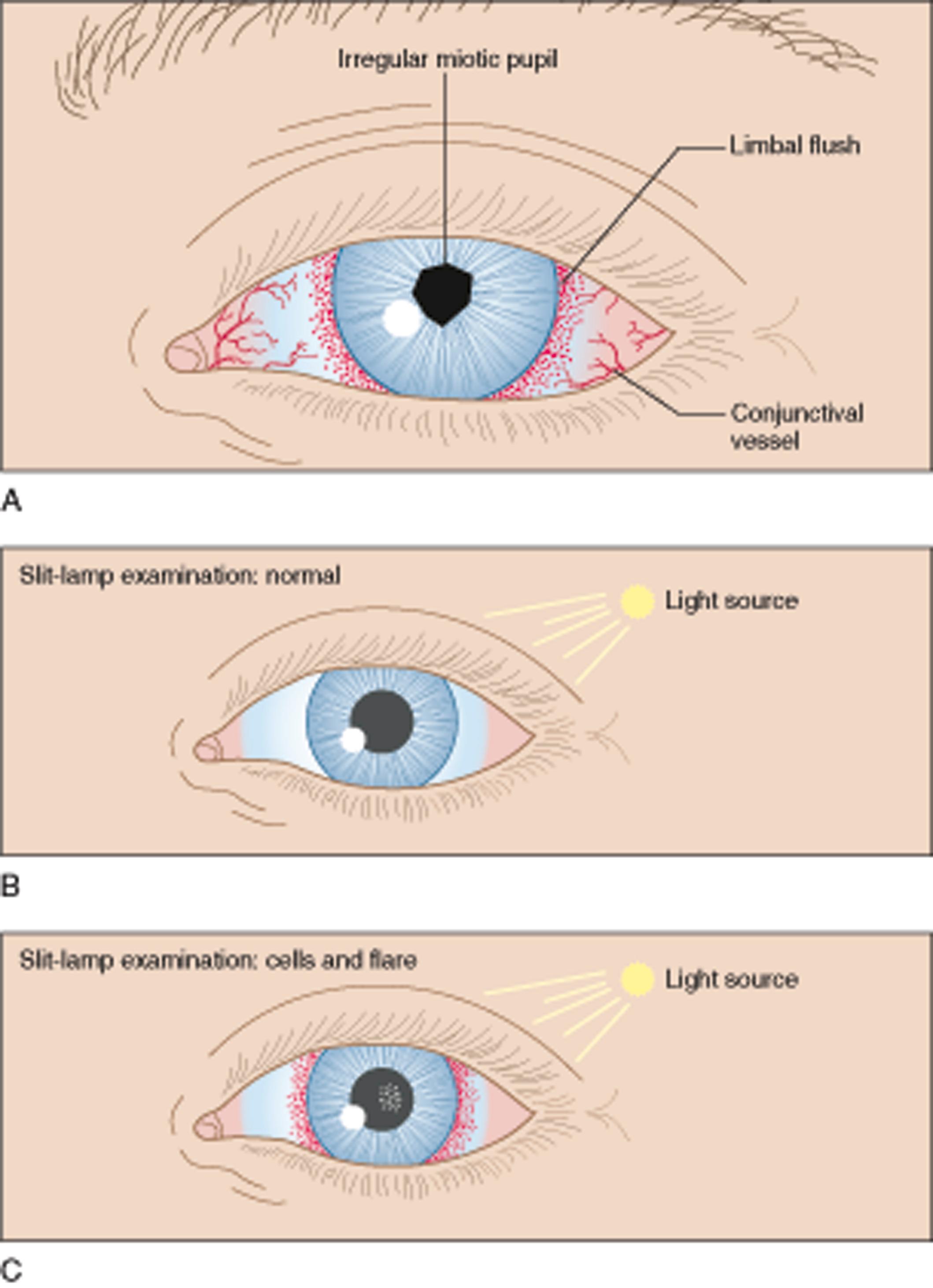 Iritis Acute Anterior Uveitis Clinical Tree