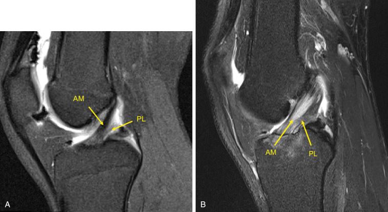 Isolated Single-Bundle Reconstruction - Clinical Tree