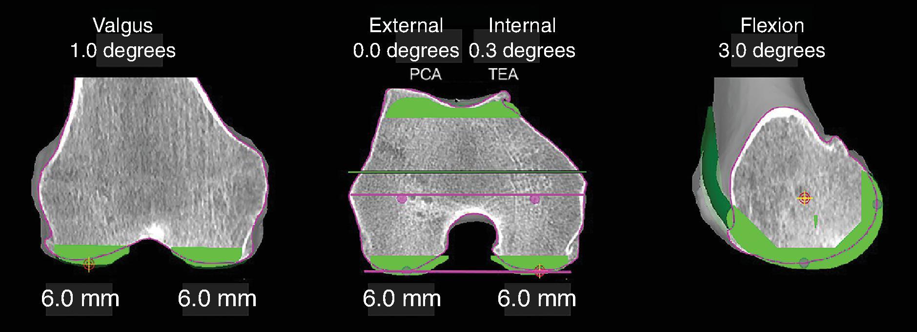 Kinematic Alignment With Image-Based Robotic Instrumentation - Clinical ...