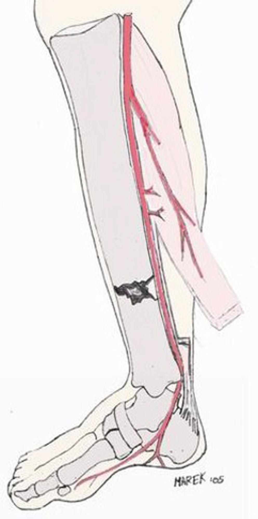 Leg Reconstruction: Distal Third (Local Flaps) - Clinical Tree