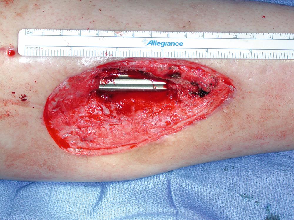 Leg Reconstruction: Middle Third - Clinical Tree