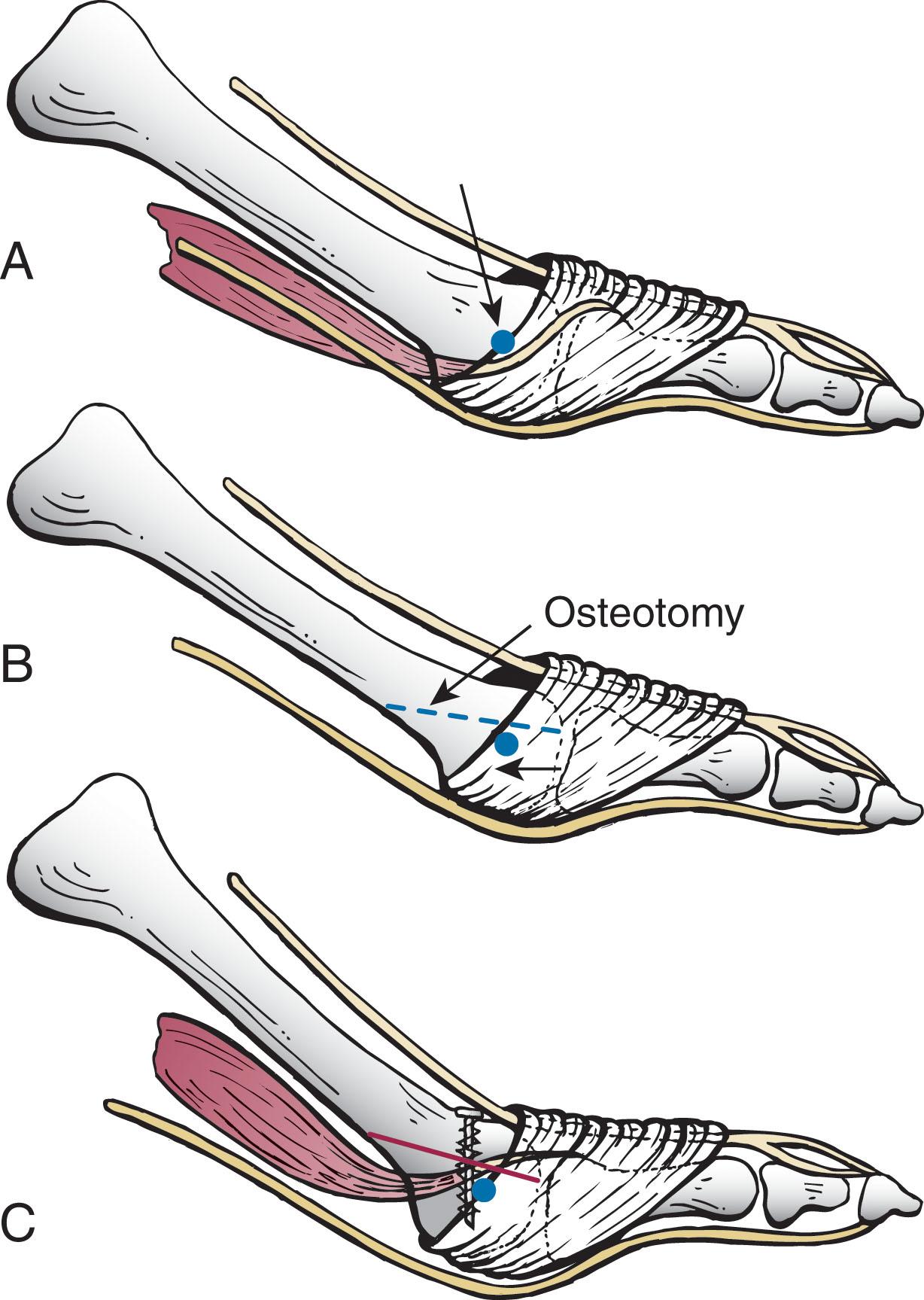 Lesser Toe Deformities - Clinical Tree