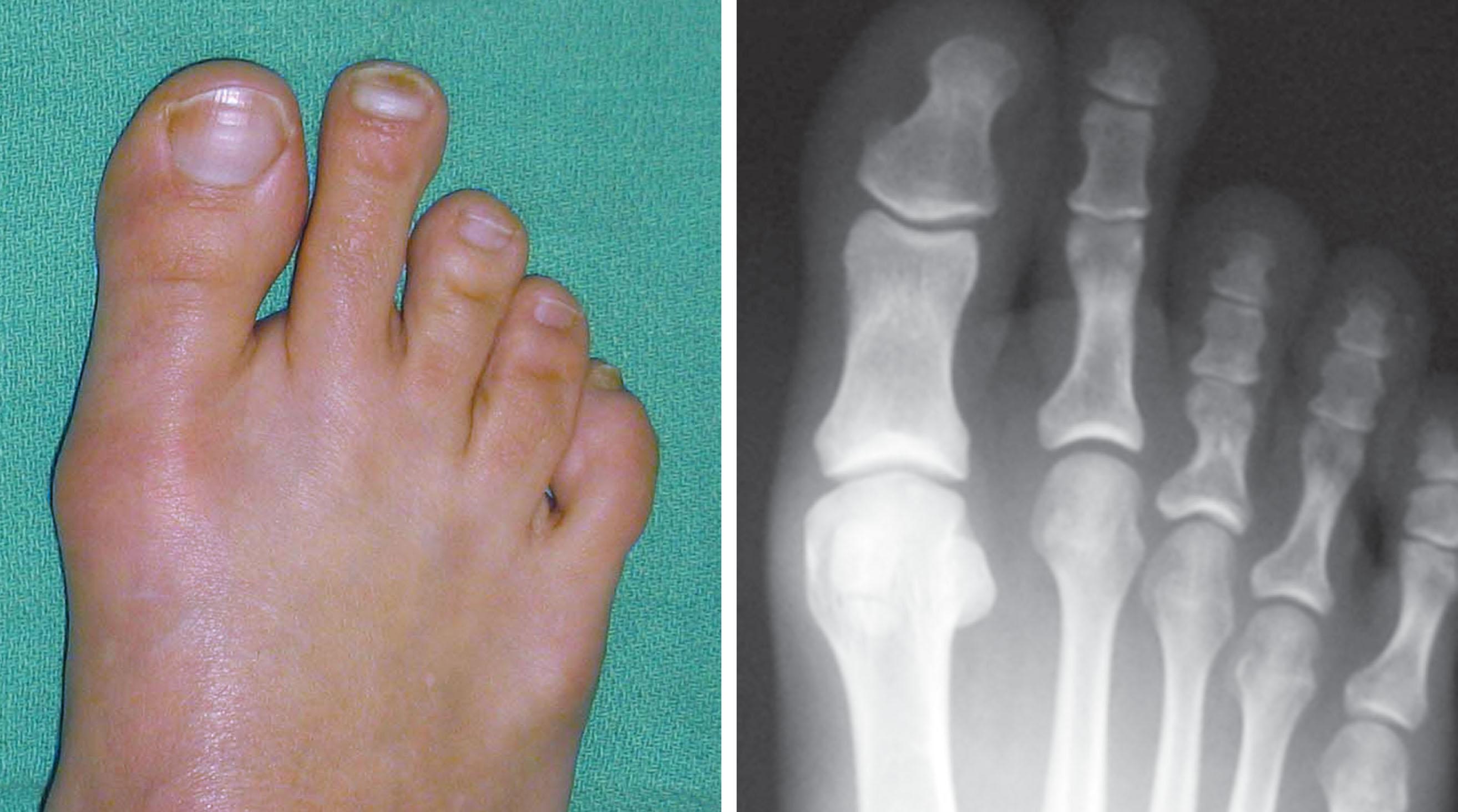 Lesser Toe Deformities - Clinical Tree
