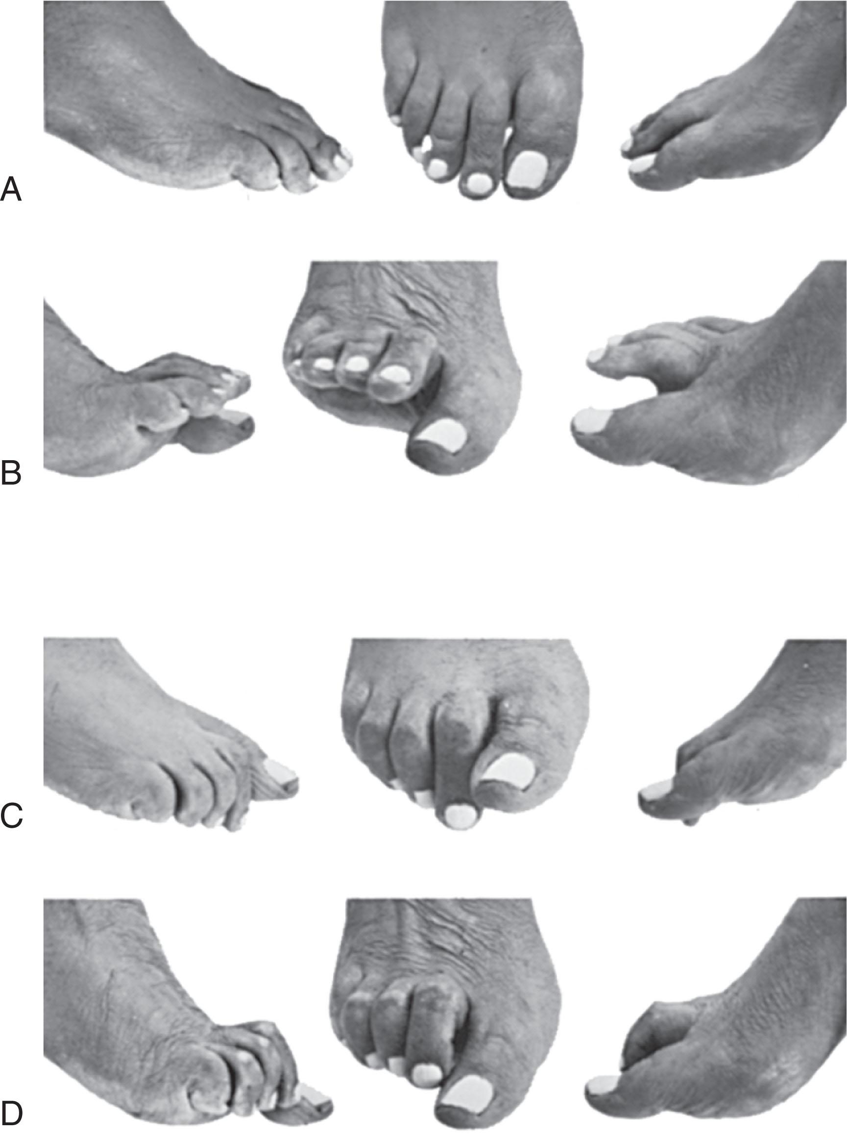 Lesser Toe Deformities - Clinical Tree