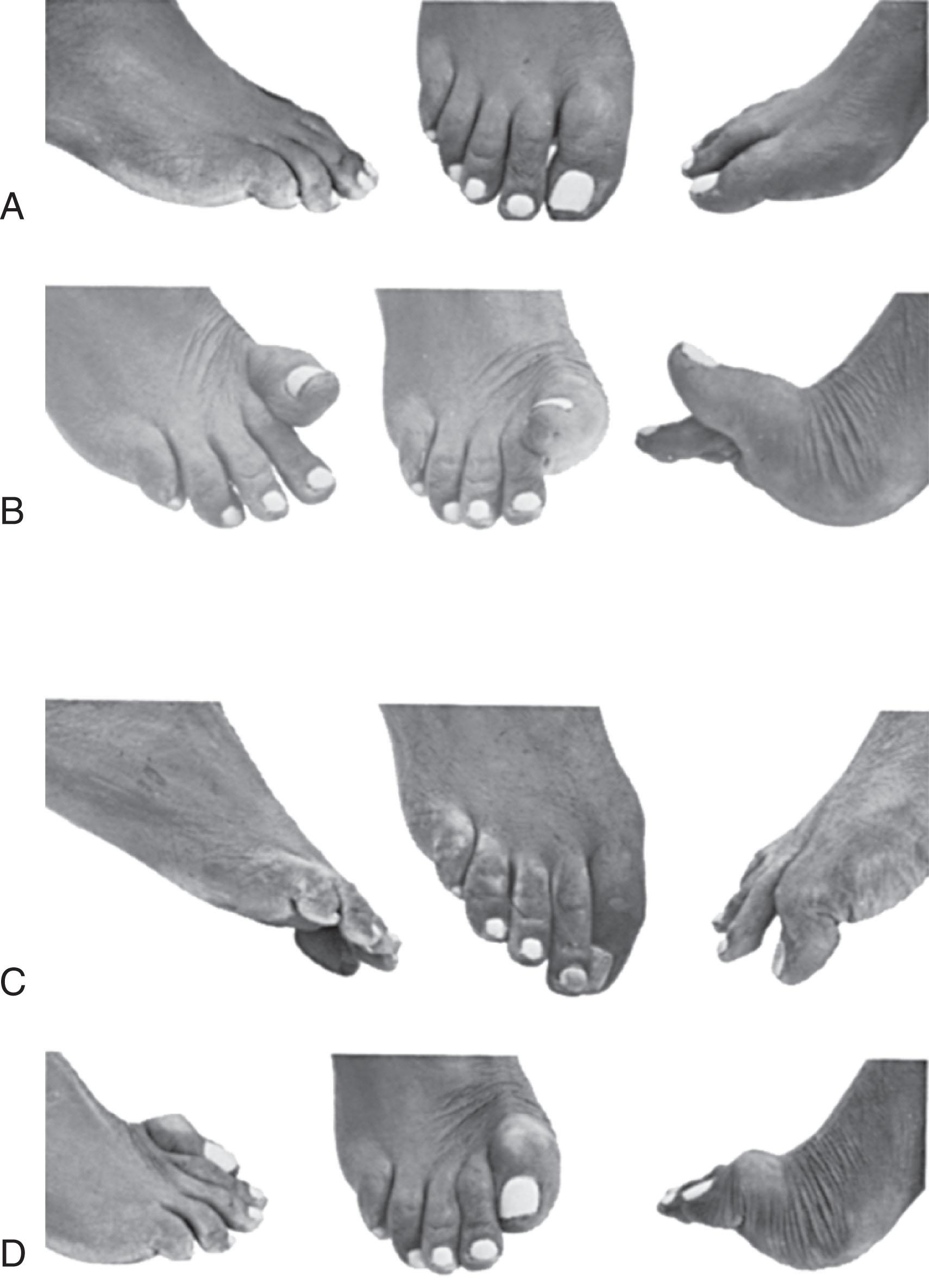 Lesser Toe Deformities - Clinical Tree