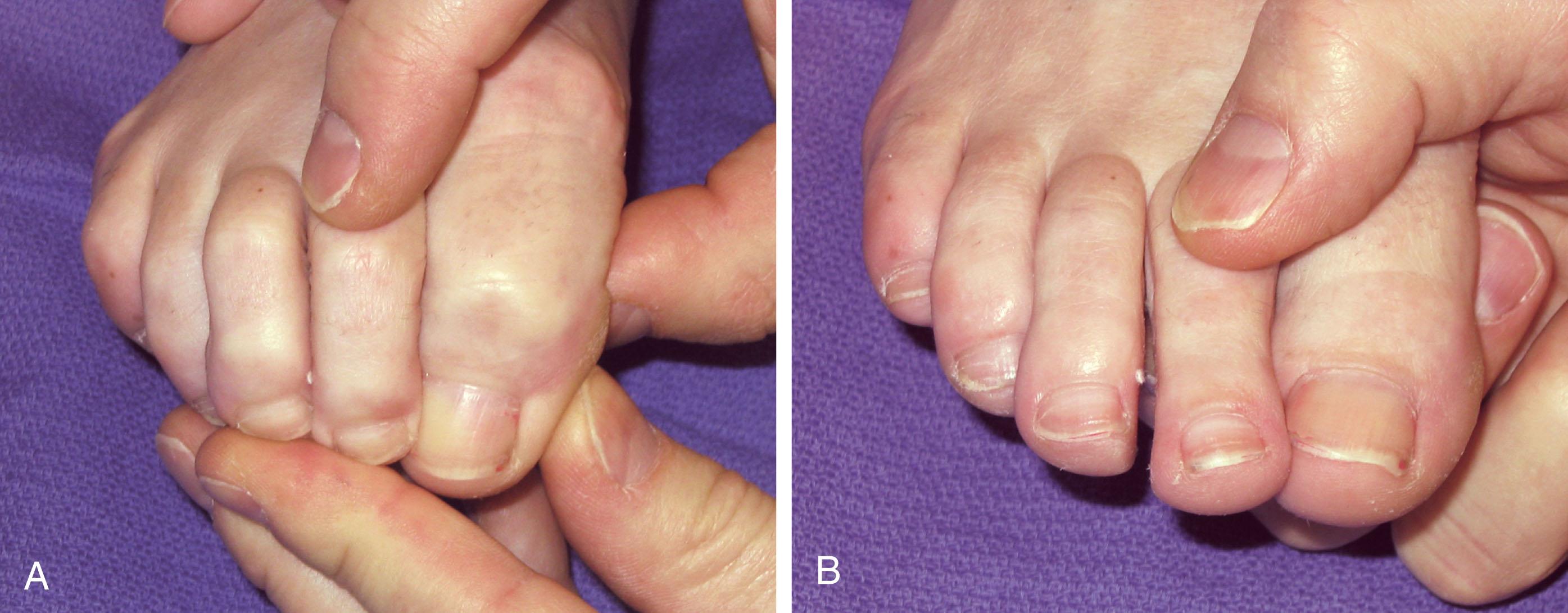 Lesser Toe Deformities - Clinical Tree