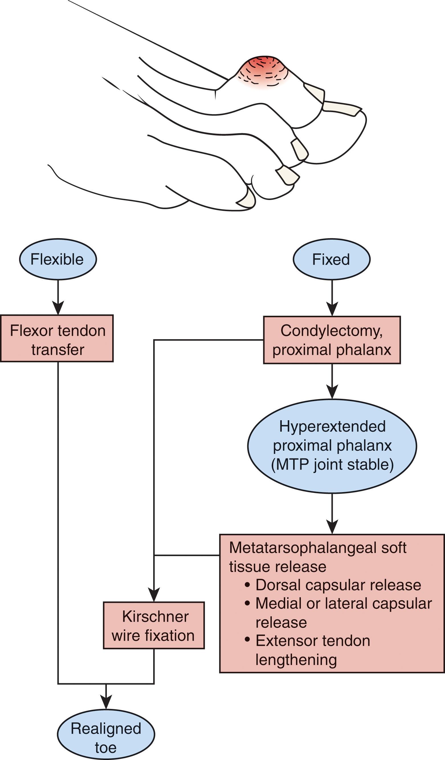 Lesser Toe Deformities - Clinical Tree