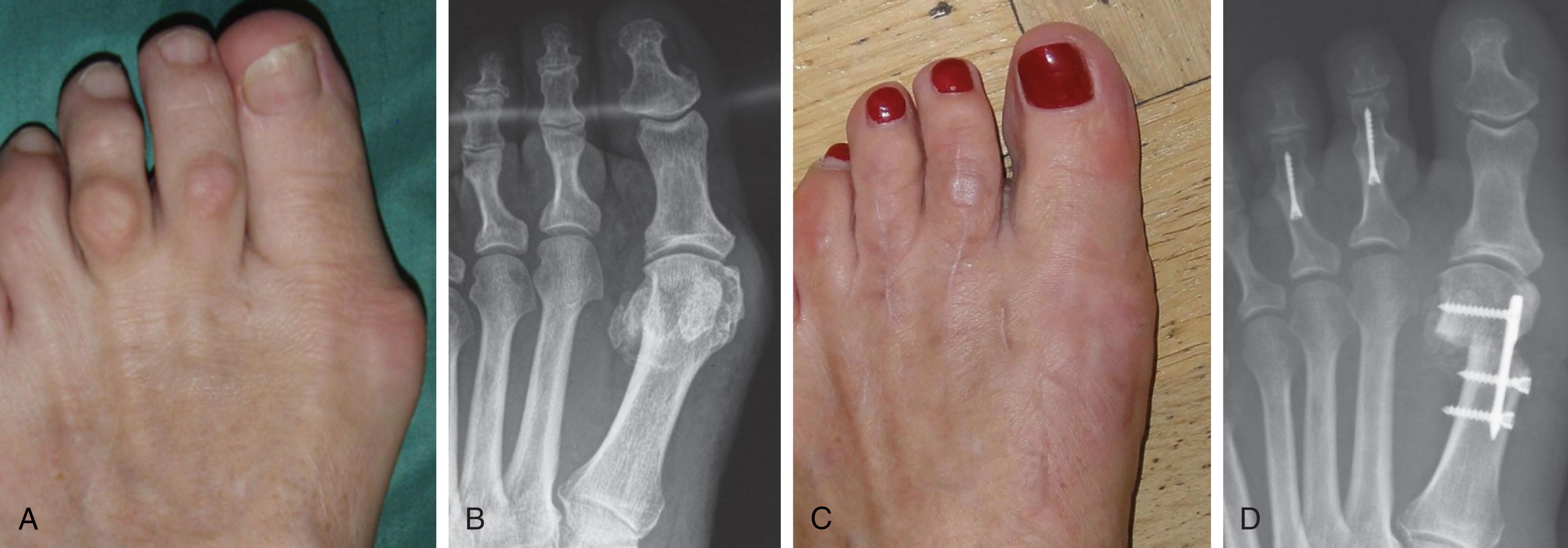 Lesser Toe Deformities - Clinical Tree