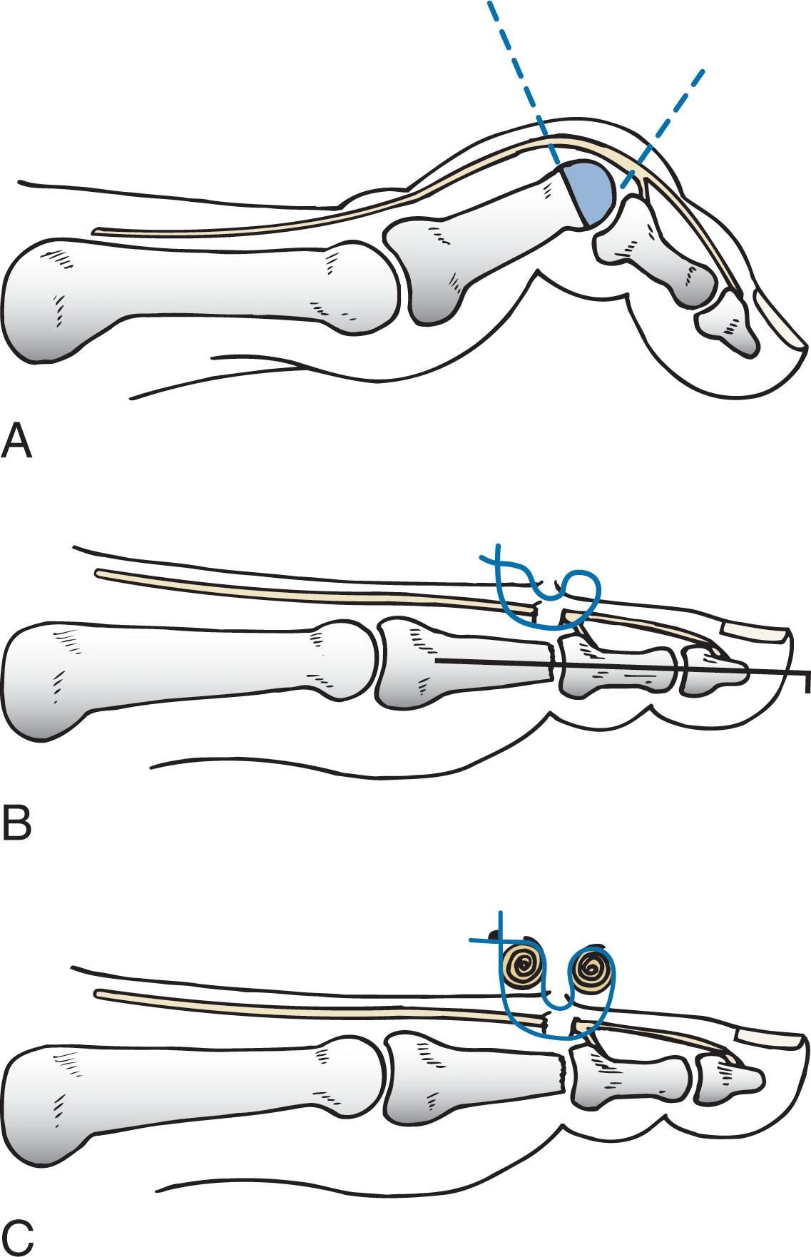 Lesser Toe Deformities - Clinical Tree