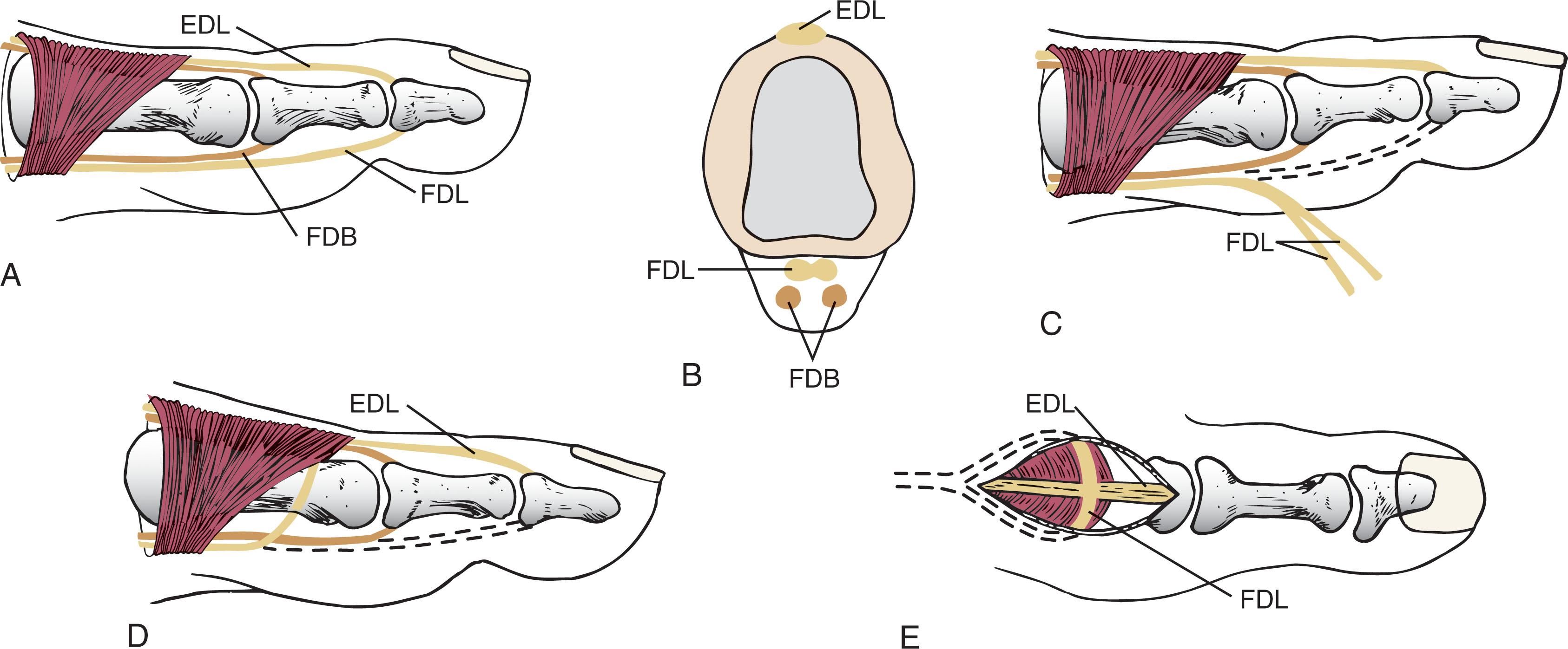 Lesser Toe Deformities - Clinical Tree