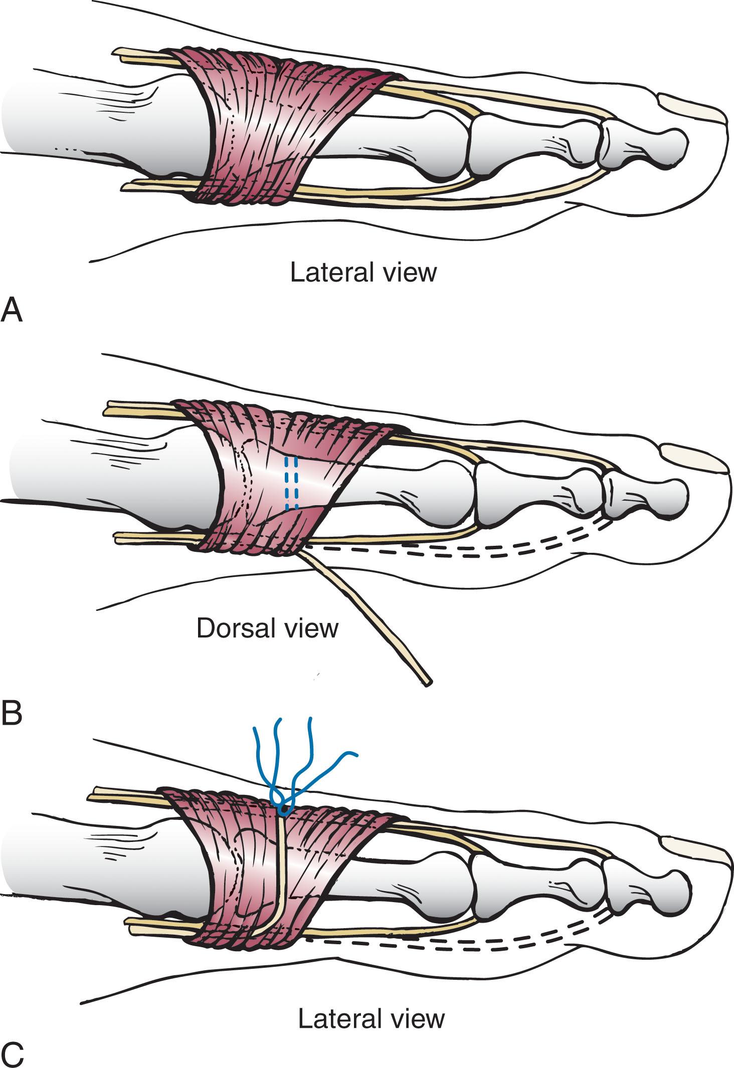 Lesser Toe Deformities - Clinical Tree
