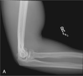 Loss of Elbow Motion - Clinical Tree