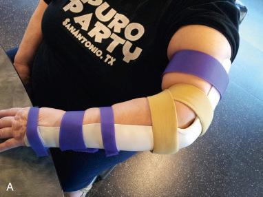 Loss of Elbow Motion - Clinical Tree