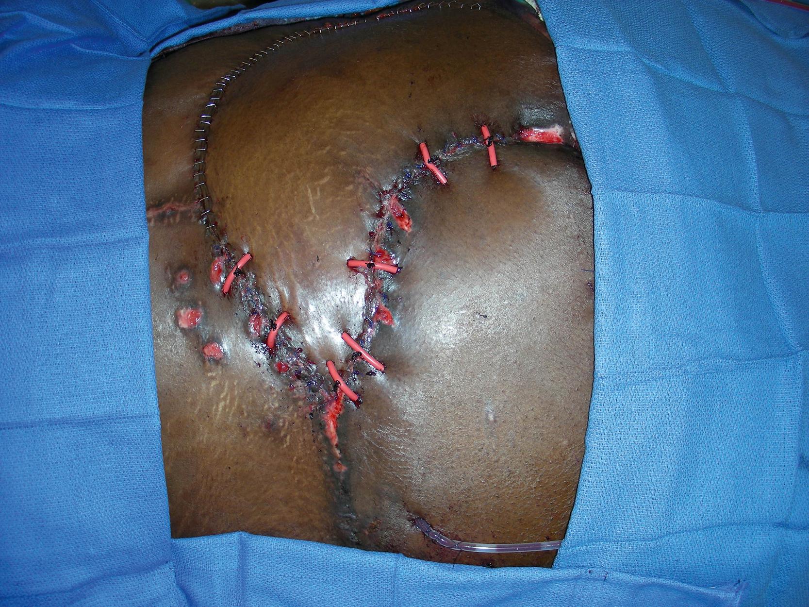 Lower Back Reconstruction - Clinical Tree