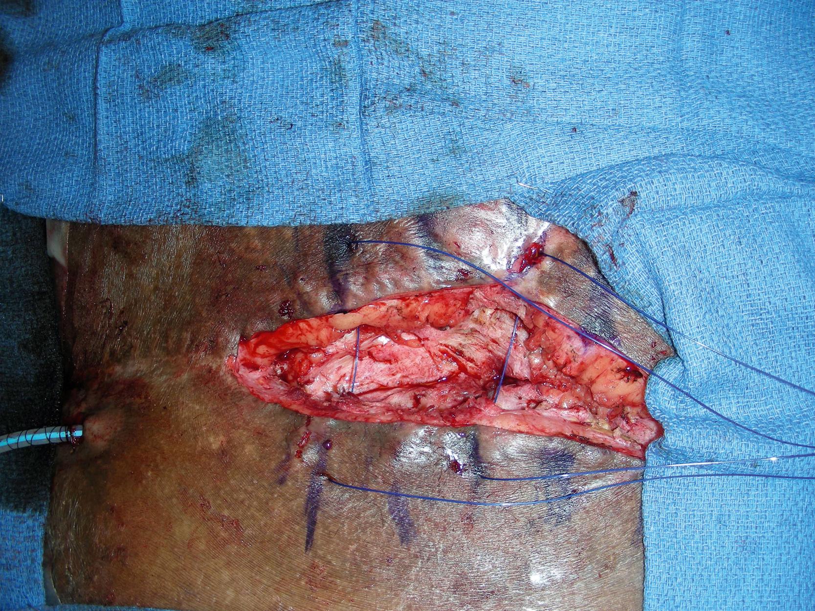 Lower Back Reconstruction - Clinical Tree