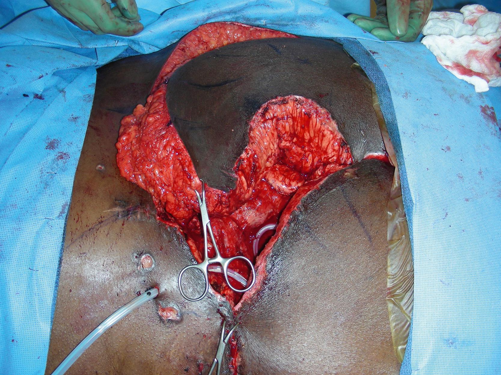 Lower Back Reconstruction - Clinical Tree