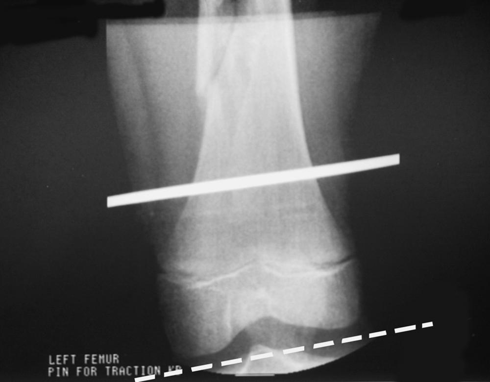 Lower Extremity Injuries - Clinical Tree