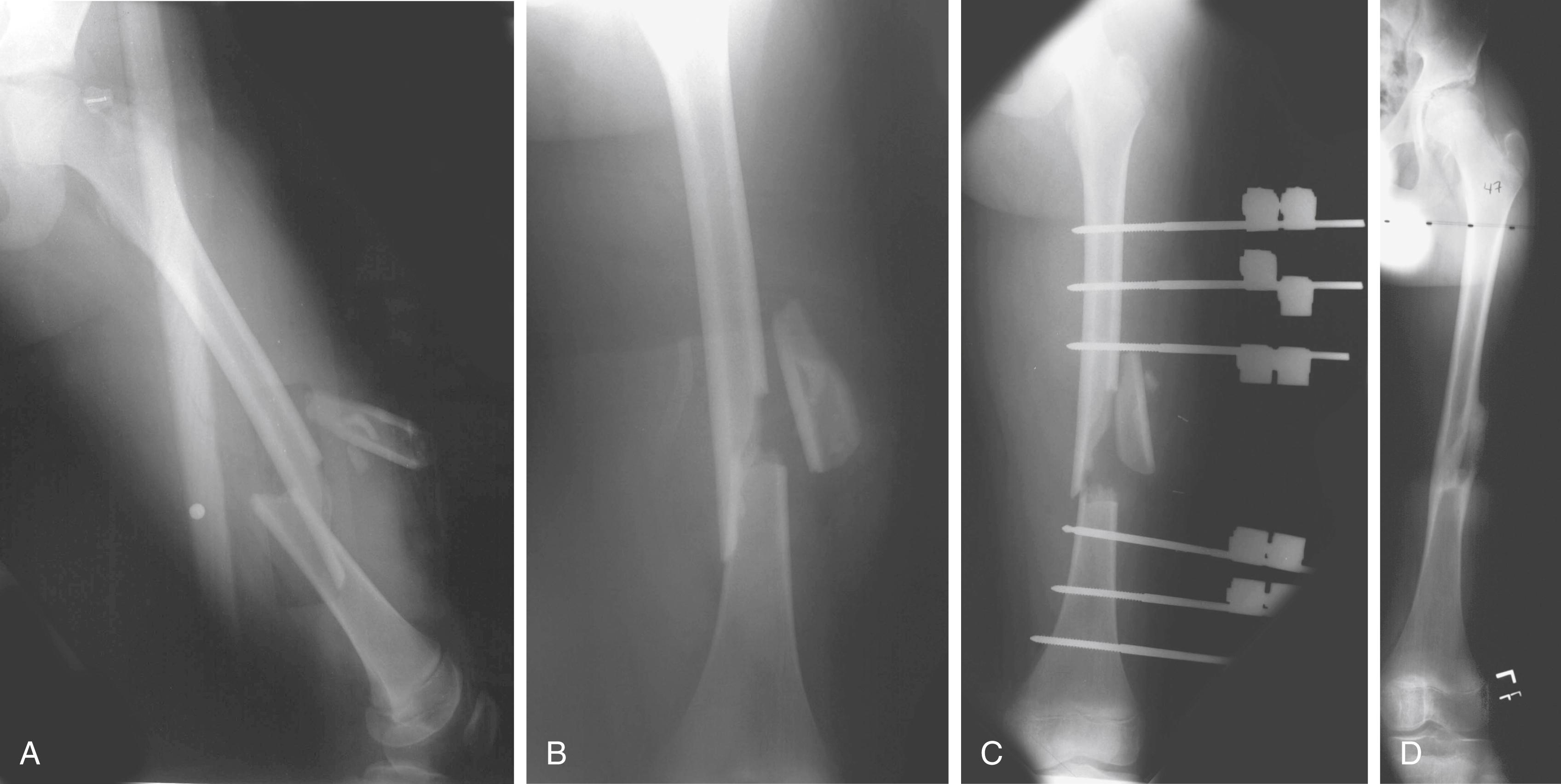 Lower Extremity Injuries - Clinical Tree