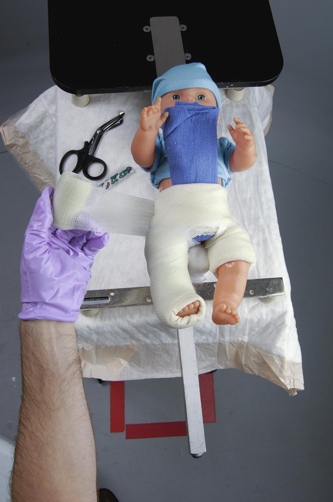 Lower Extremity Splints and Casts - Clinical Tree