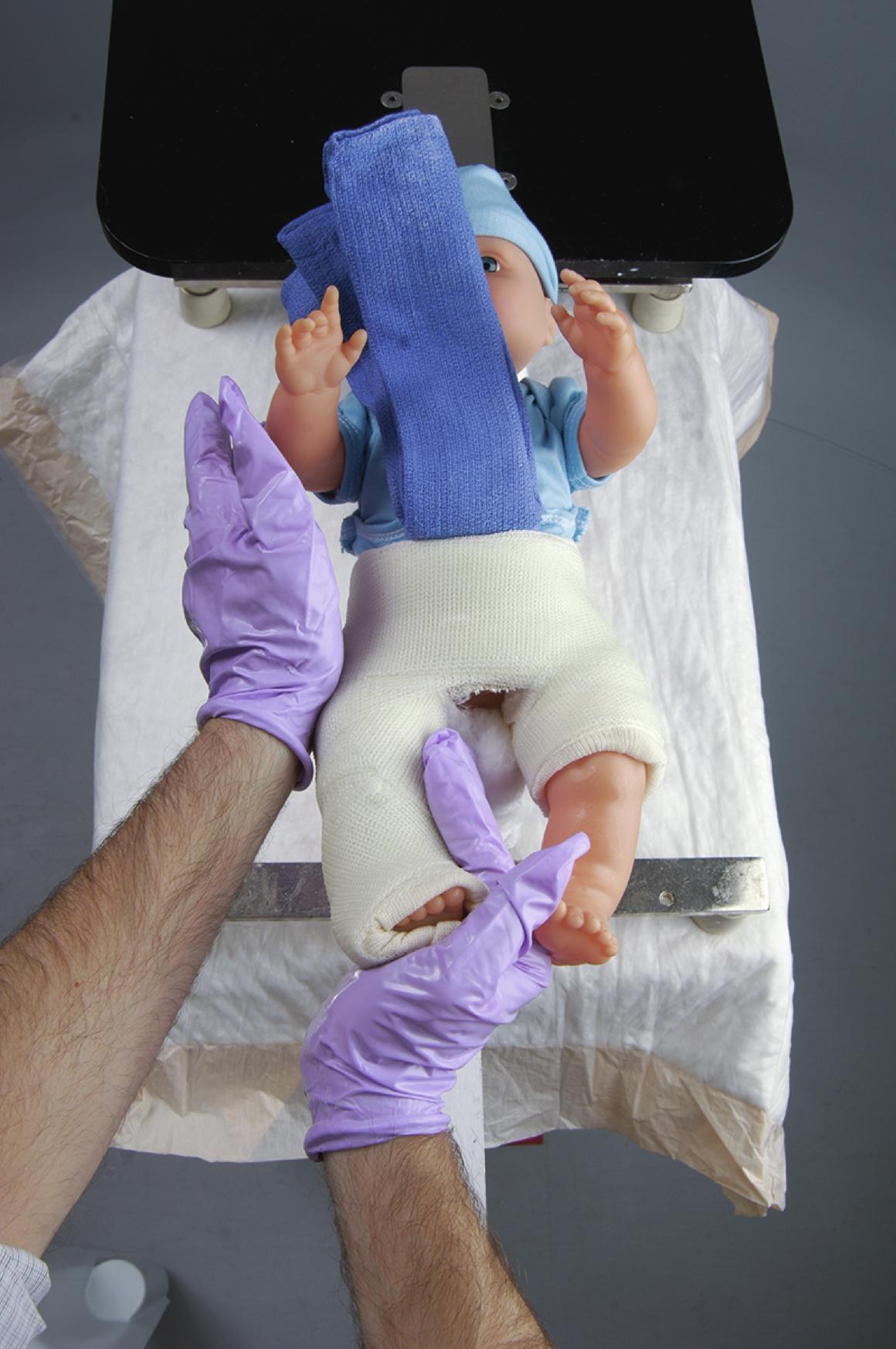 Lower Extremity Splints and Casts - Clinical Tree