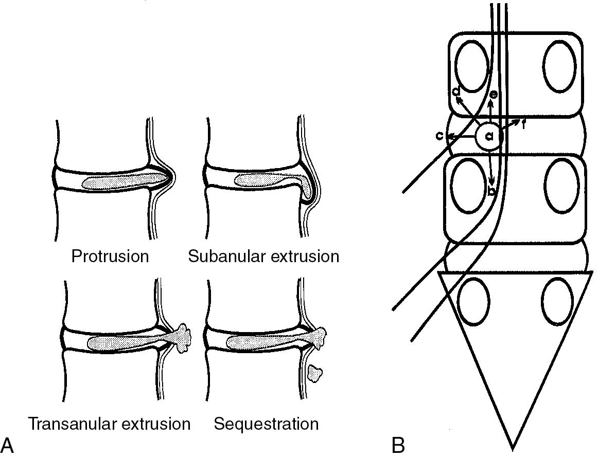 Lumbar Disc Herniation Clinical Tree