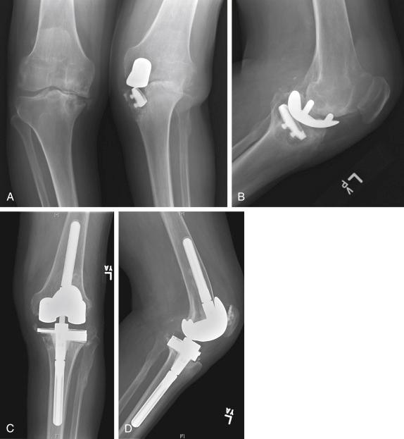 Management of Bone Defects Using Bone Graft - Clinical Tree