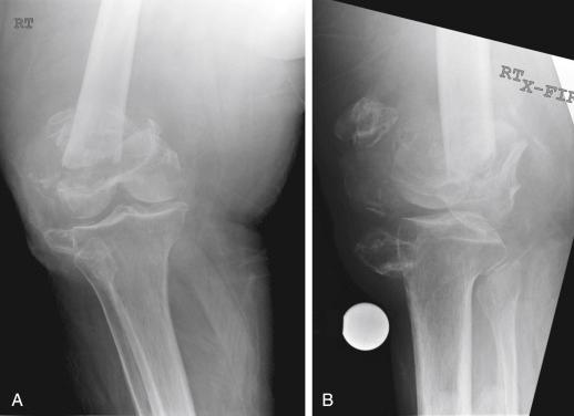 Management of Knee Instability: Use of Hinged Implants - Clinical Tree