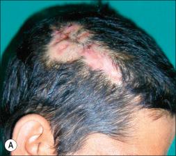 Management of Postburn Alopecia - Clinical Tree
