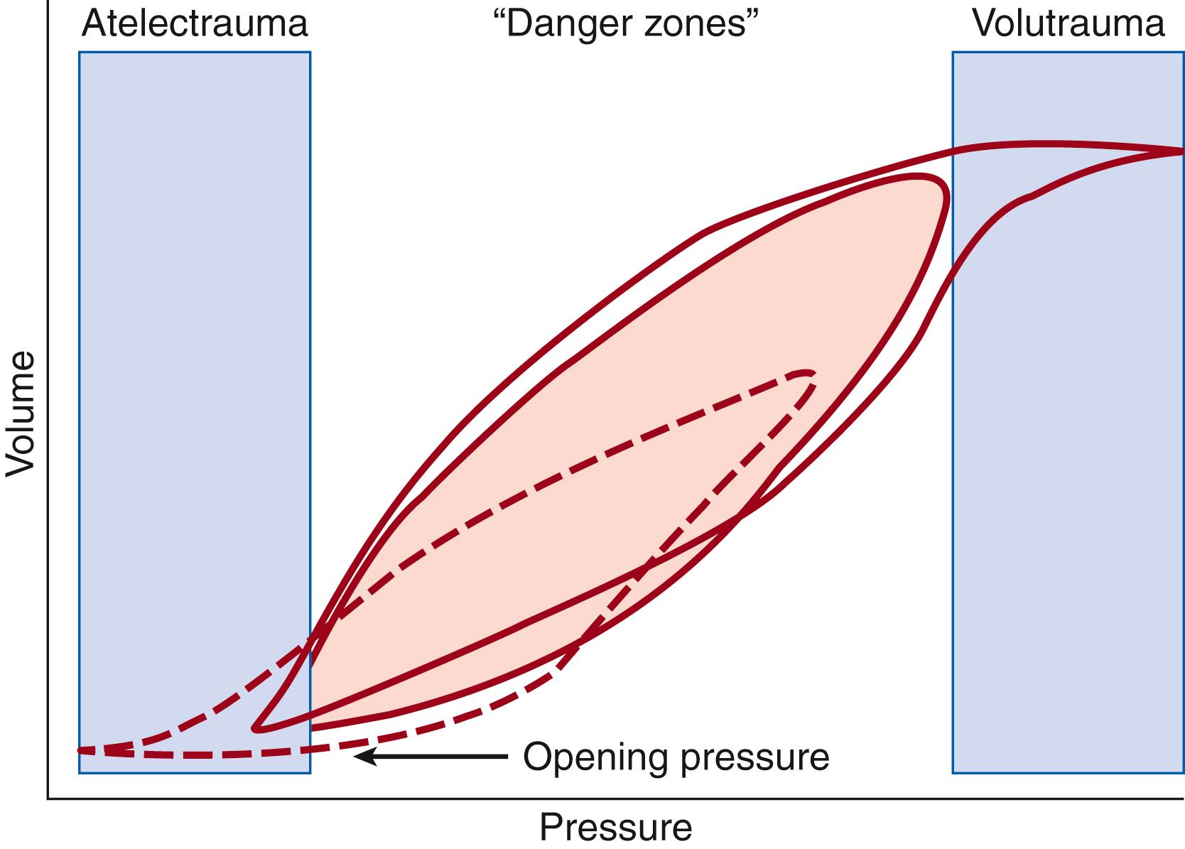 Mechanisms of Neonatal Lung Injury - Clinical Tree