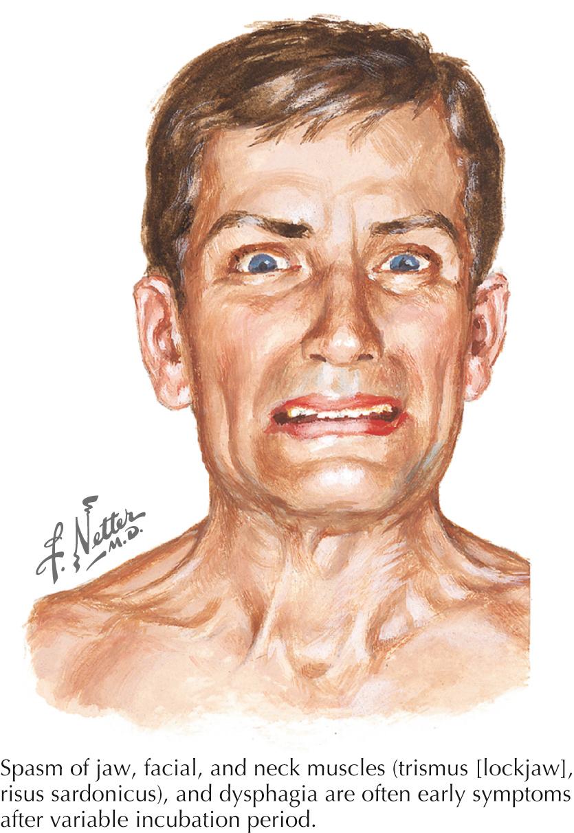 Medication-Induced Movement Disorders - Clinical Tree