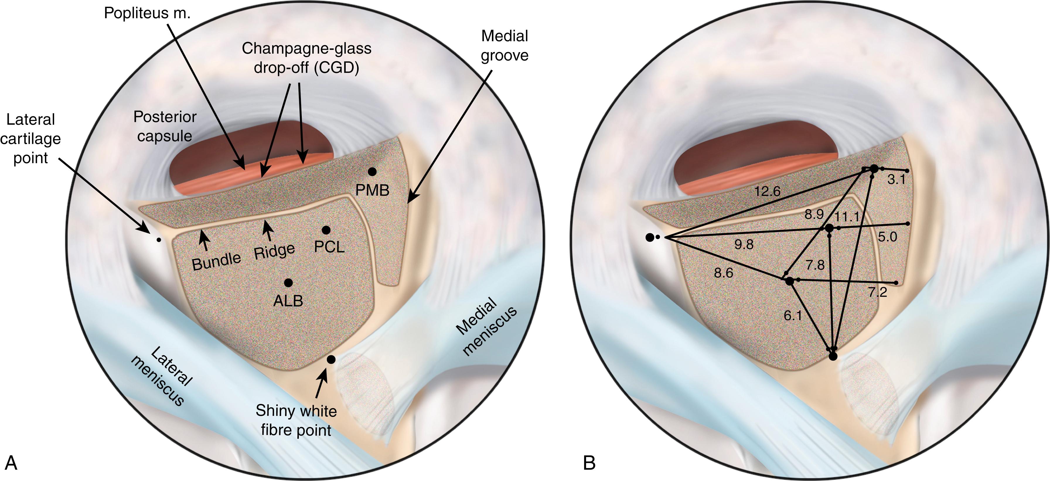 Meniscal Root Tears - Clinical Tree