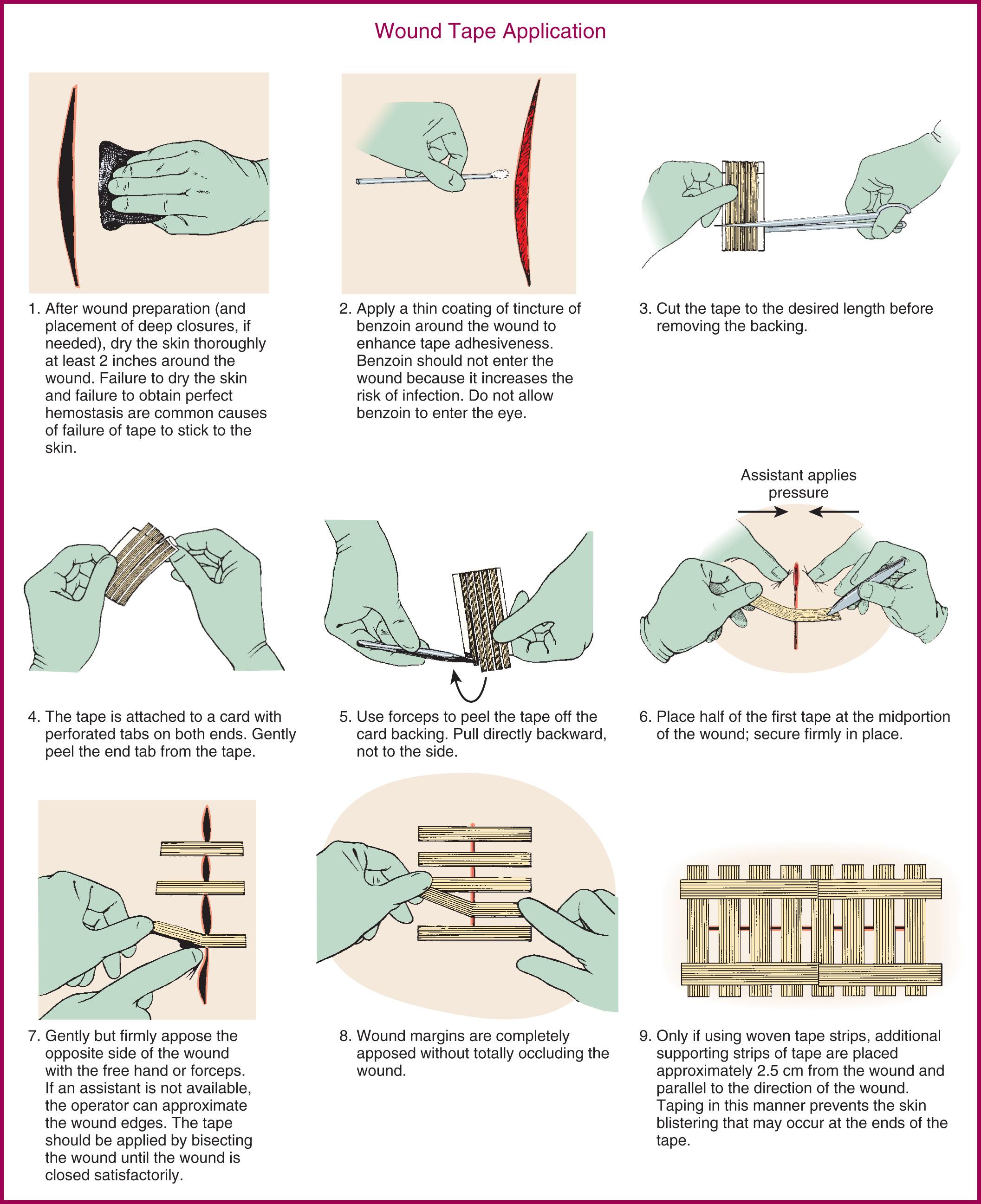 Methods of Wound Closure - Clinical Tree