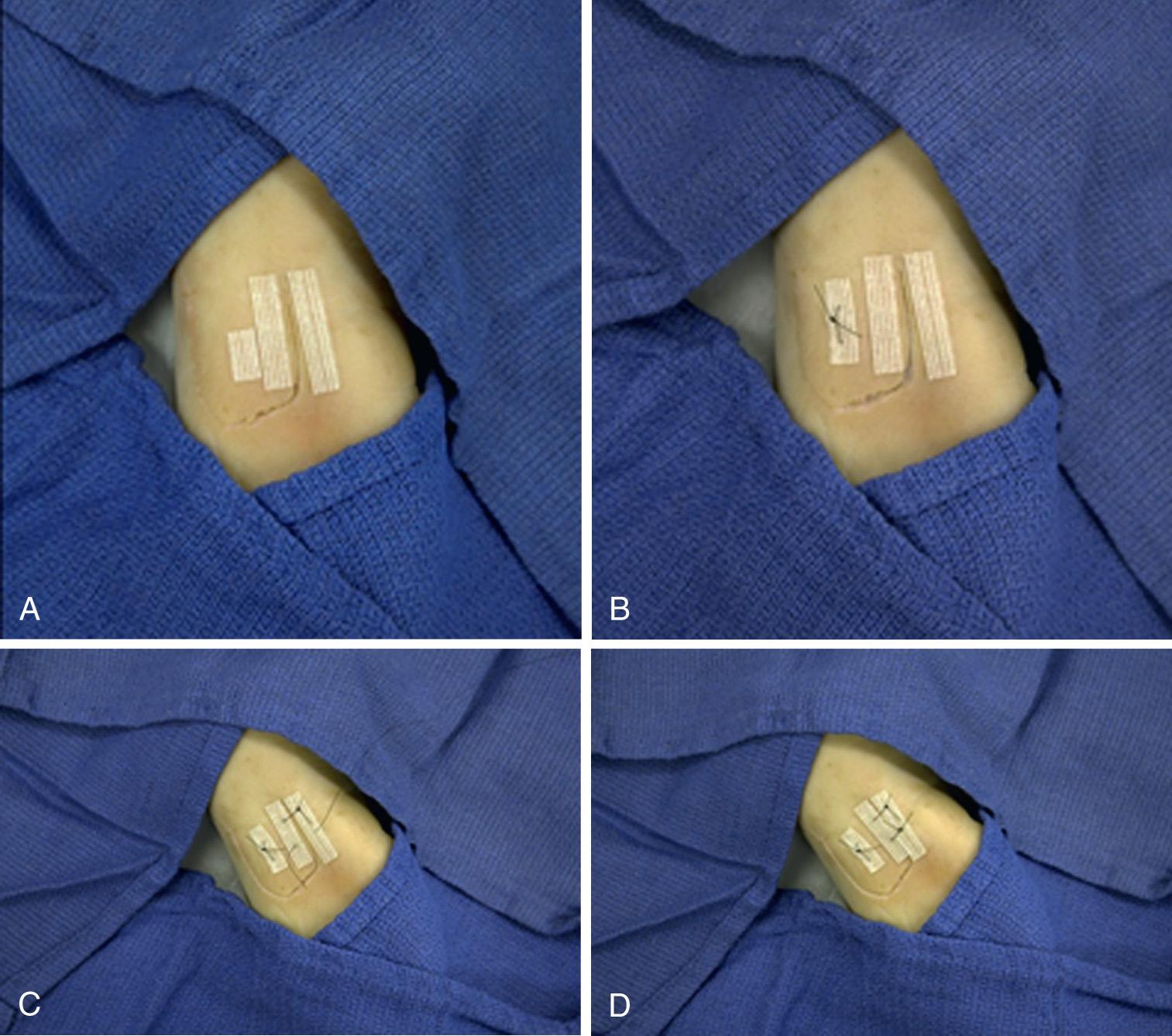 Methods of Wound Closure - Clinical Tree