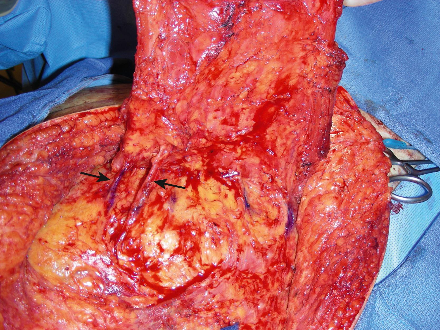 Middle Back Reconstruction - Clinical Tree