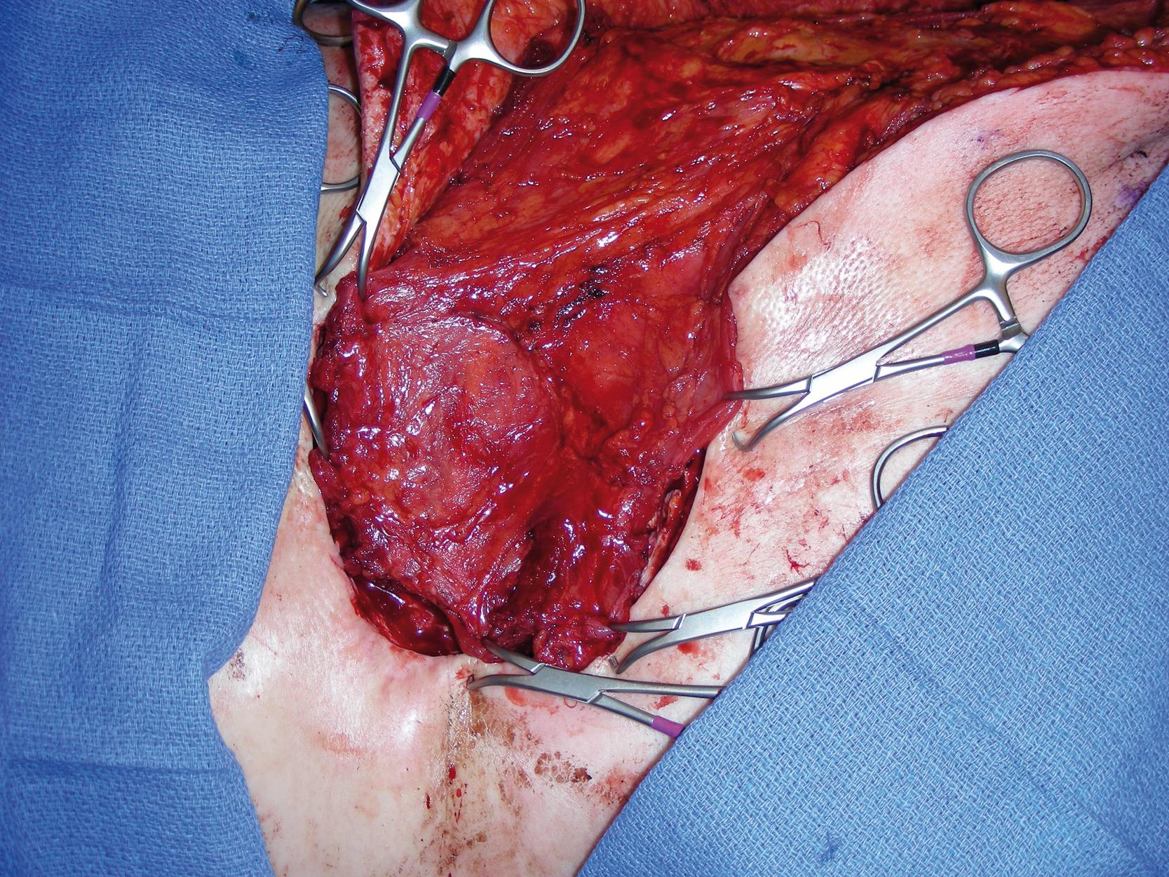 Middle Back Reconstruction - Clinical Tree